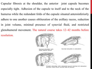 6. frozen shoulder 2024-2025.pdf