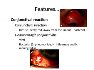 6. conjunctival disease nd trachoma.ppts