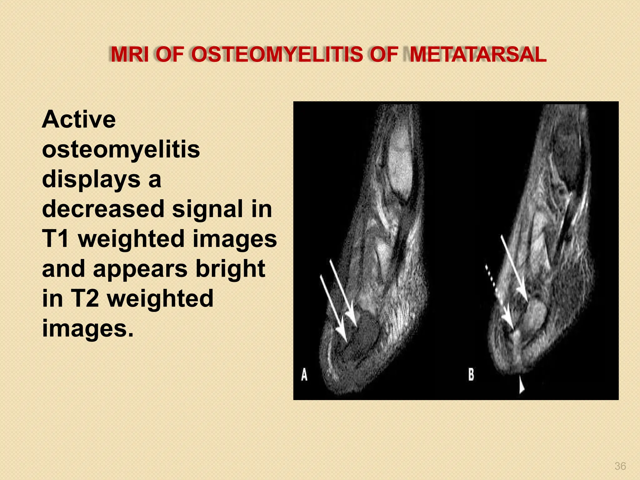 6.new Osteomyelitis.pptx osteomyelitis othopedic extrnsive | PPT