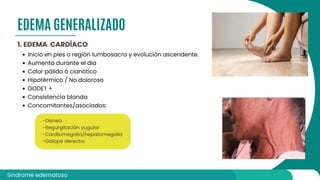 Síndrome edematoso propedéutica clínica 2025.pdf