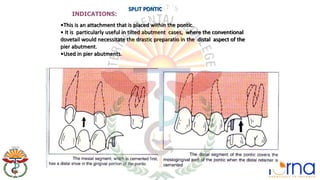 6.-connectors-for-fixed partial denture fpd.pdf