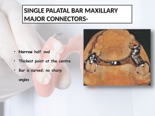 MAJOR CONNECTORS IN REMOVABLE PARTIAL DENTURE | PPTX