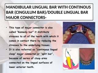 MAJOR CONNECTORS IN REMOVABLE PARTIAL DENTURE | PPTX