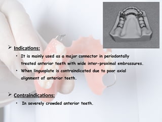 MAJOR CONNECTORS IN REMOVABLE PARTIAL DENTURE | PPTX