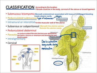 6.UTERINE FIBROIDs with all types of fibroid | PDF
