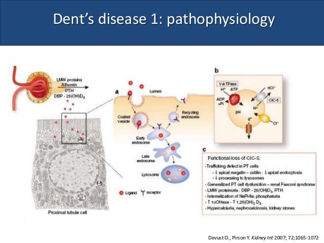 6-3. Dent's disease. Larisa Prikhodina (eng)