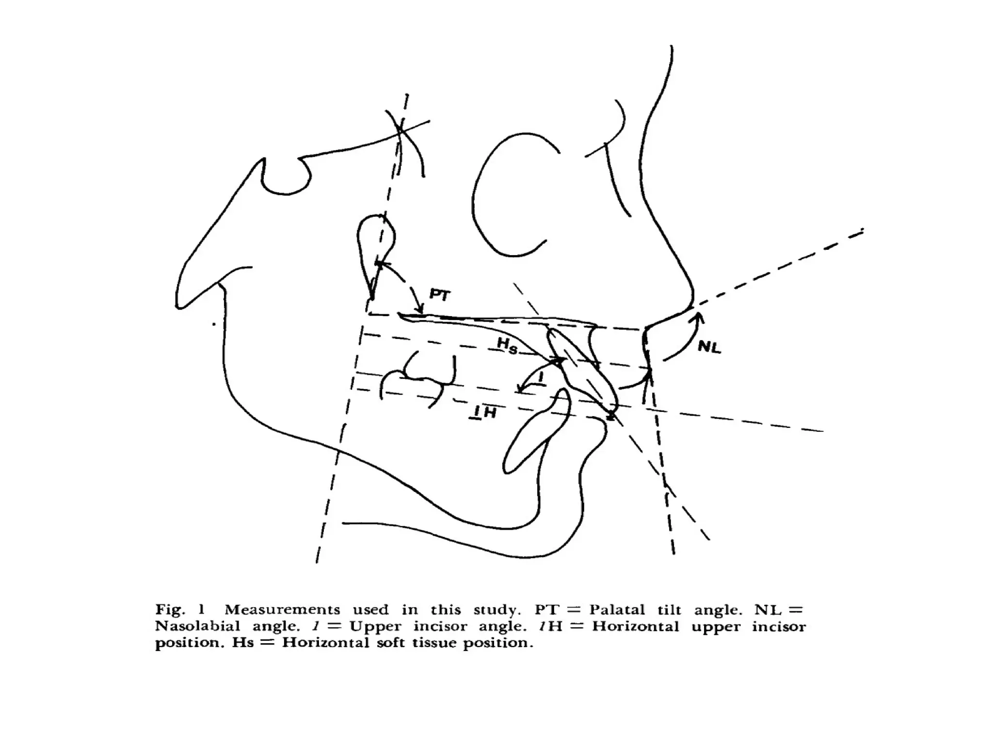 6-6- 24 soft tissue retraction ORTHODONTICS.pptx
