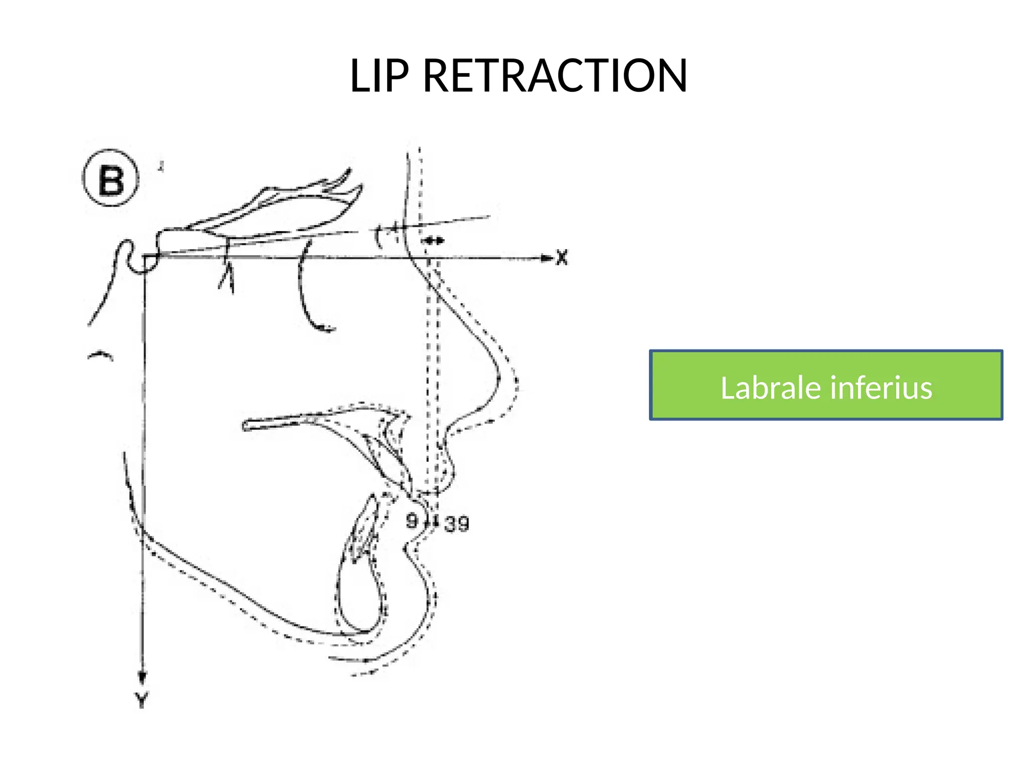 6-6- 24 soft tissue retraction ORTHODONTICS.pptx