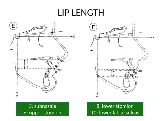 6-6- 24 soft tissue retraction ORTHODONTICS.pptx | Oral care | Personal ...