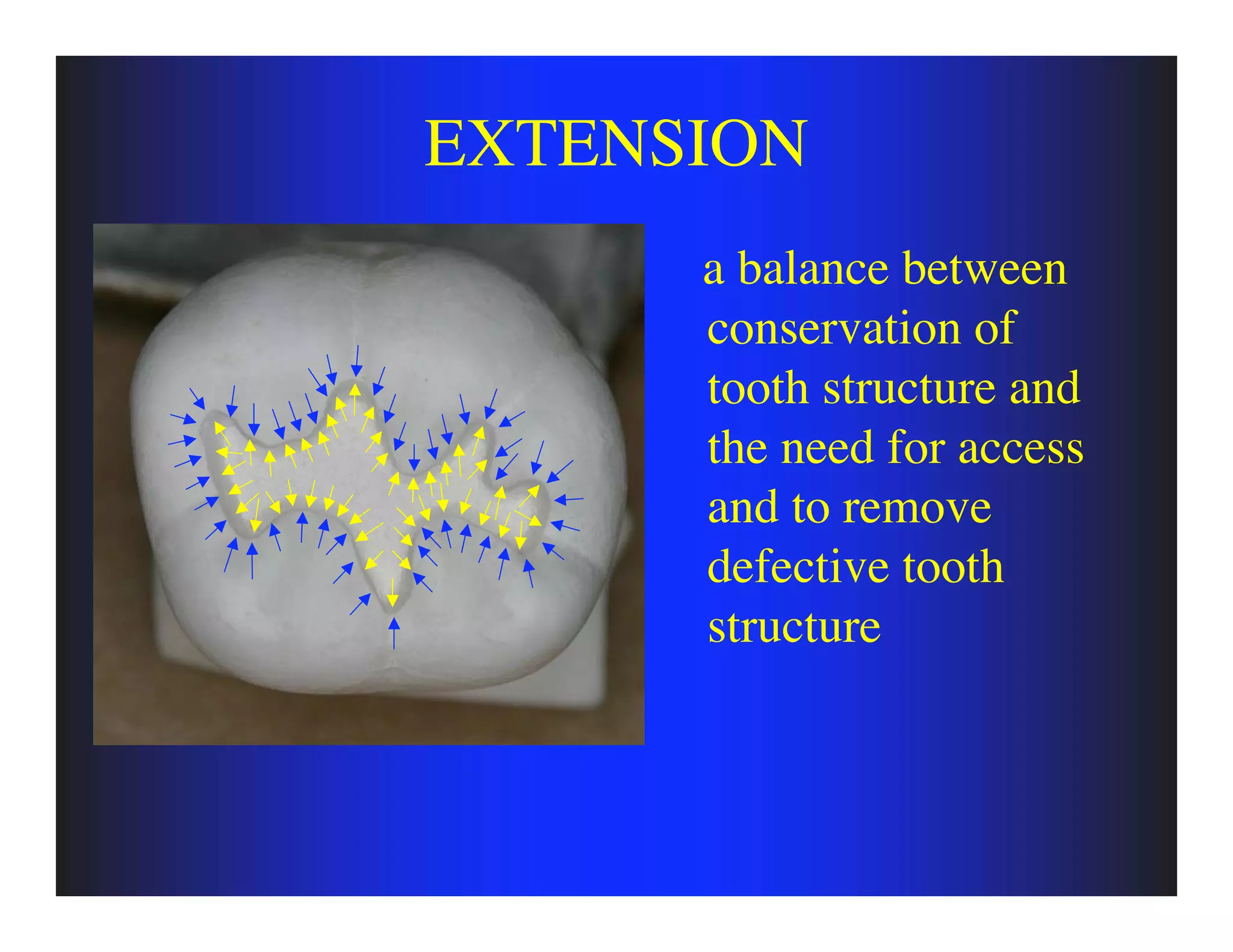principles of tooth preparation (class one) | PDF