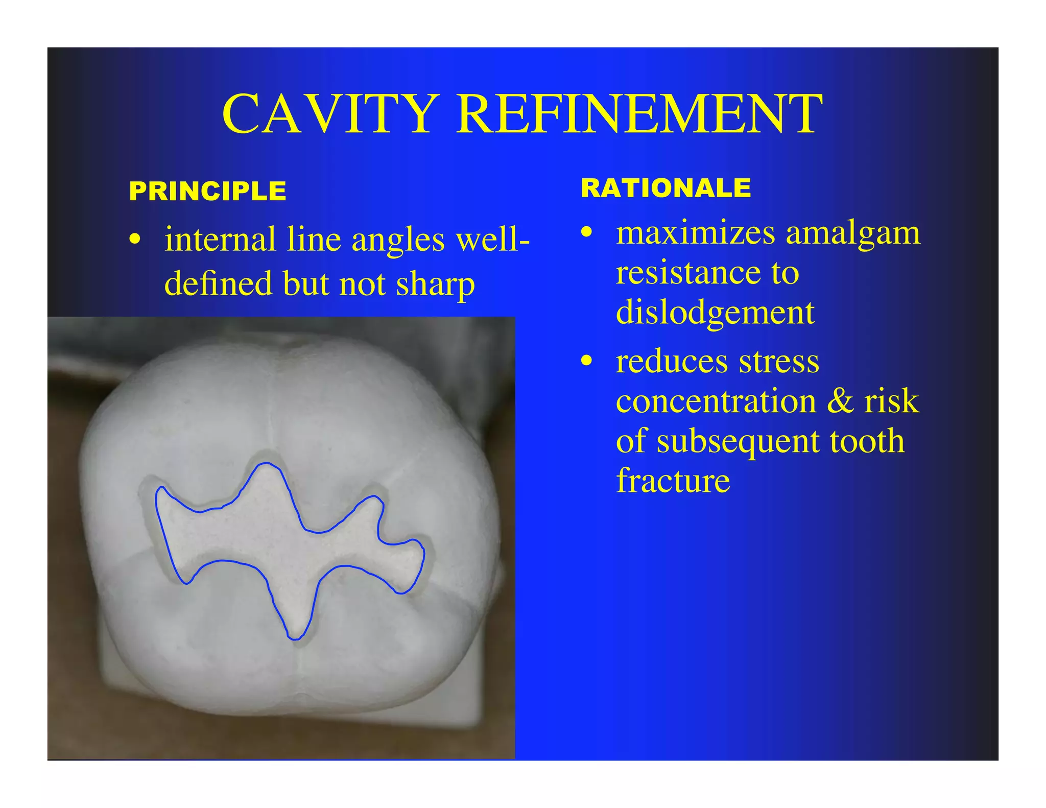 principles of tooth preparation (class one) | PDF
