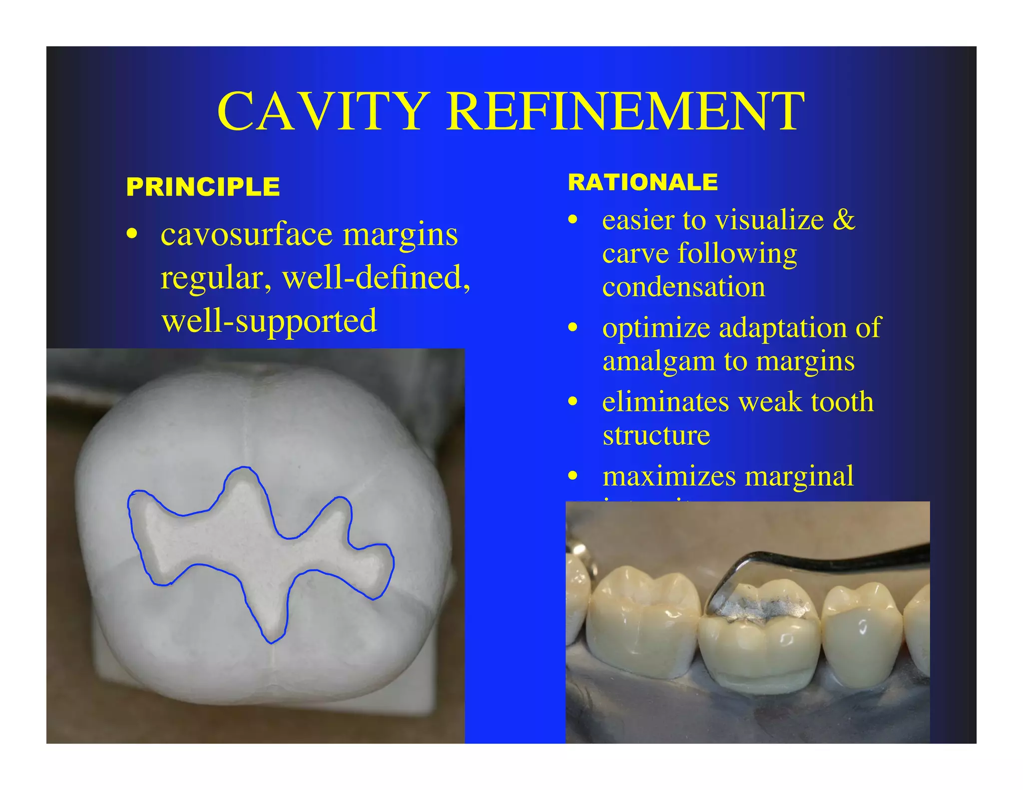 principles of tooth preparation (class one) | PDF