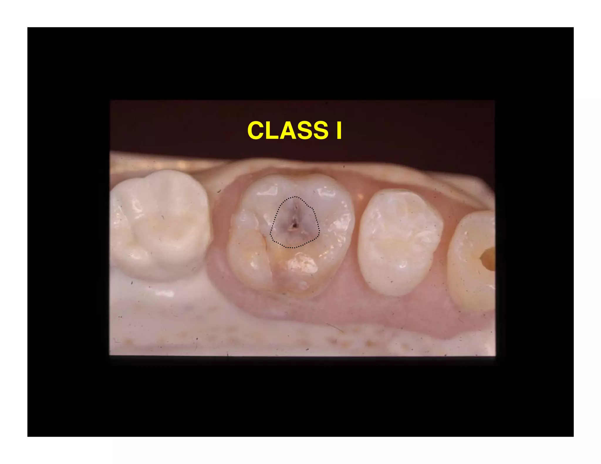 principles of tooth preparation (class one) | PDF | Dental Health ...