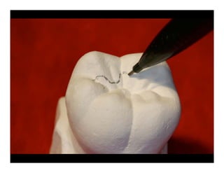 principles of tooth preparation (class one) | PDF