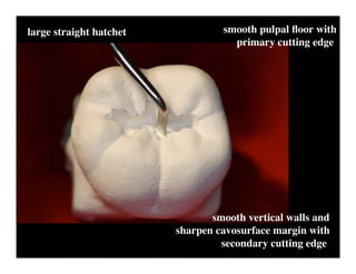 principles of tooth preparation (class one) | PDF