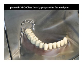 principles of tooth preparation (class one) | PDF