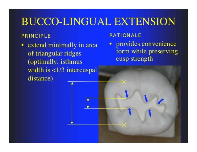 principles of tooth preparation (class one)