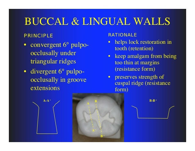 principles of tooth preparation (class one)