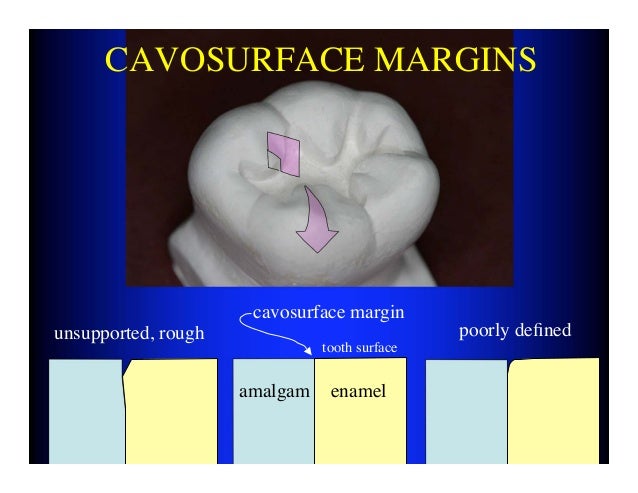 principles of tooth preparation (class one)
