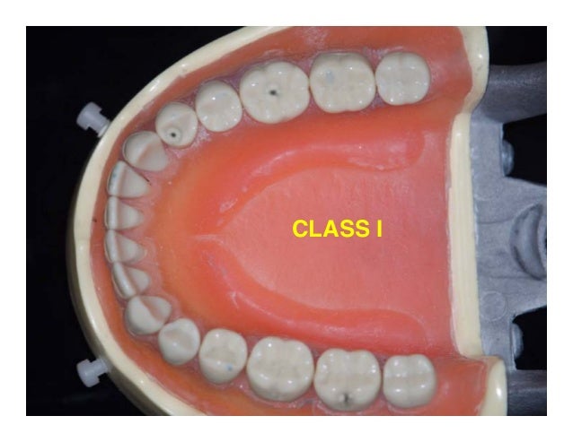 principles of tooth preparation (class one)