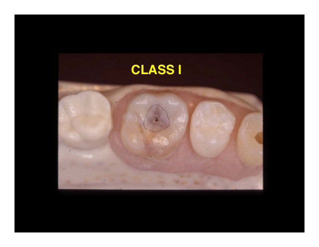 principles of tooth preparation (class one)