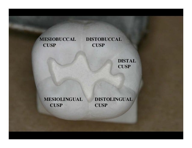principles of tooth preparation (class one)