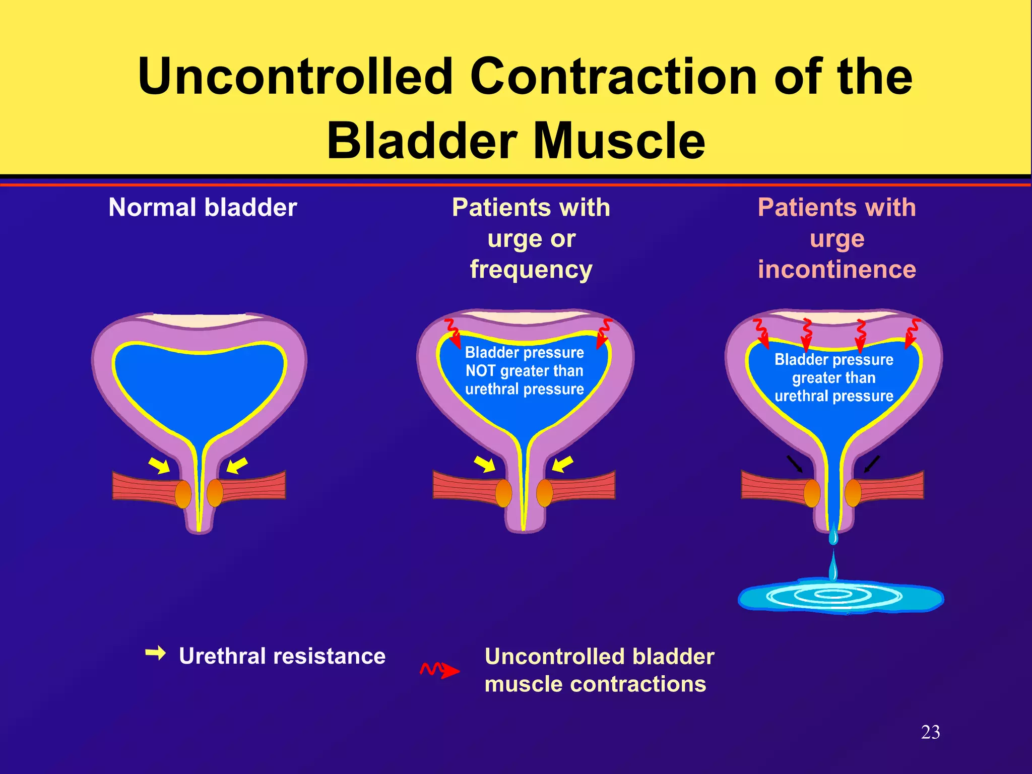 Bladder disorders(neurogenic) | PPTX