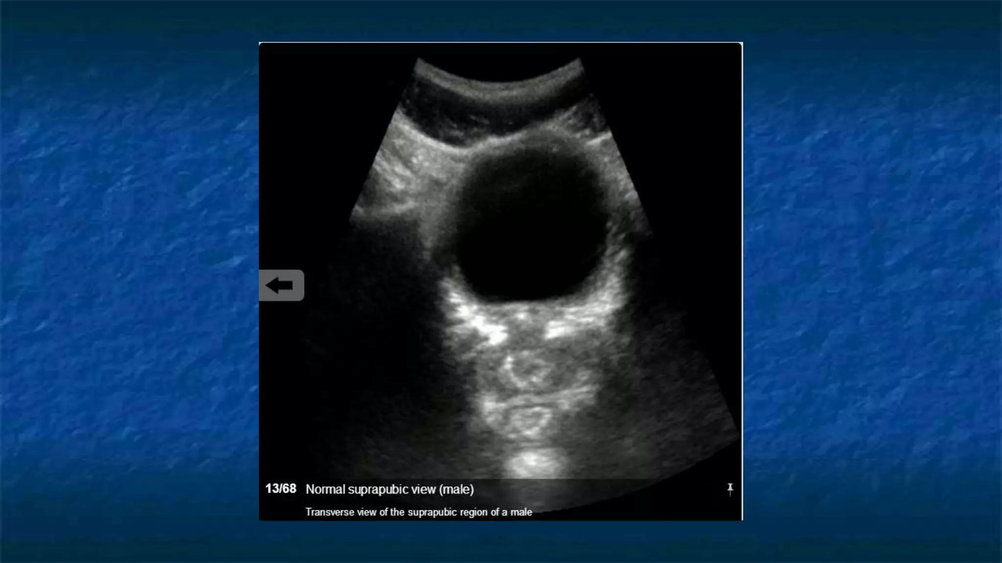 6- Abdominal Trauma and FAST Scan.pptx