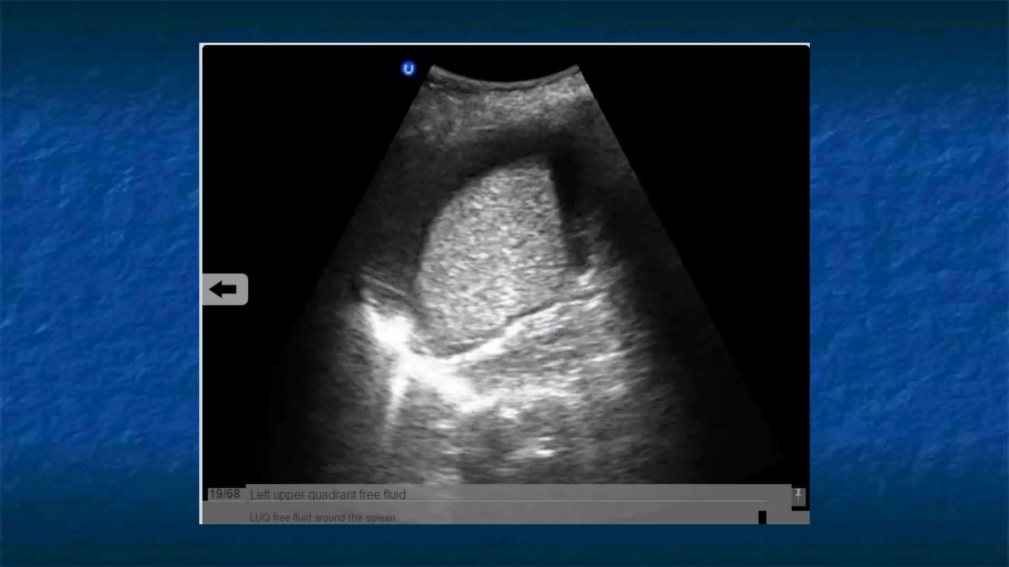 6- Abdominal Trauma and FAST Scan.pptx