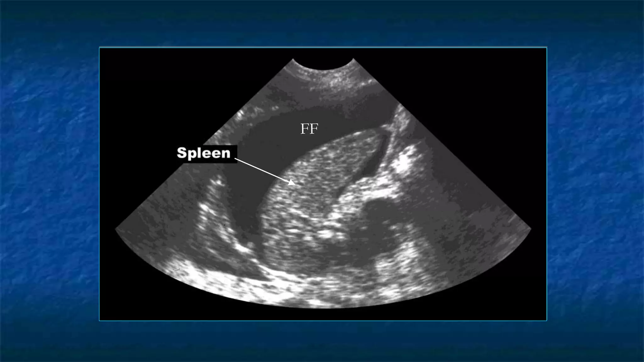 6- Abdominal Trauma and FAST Scan.pptx