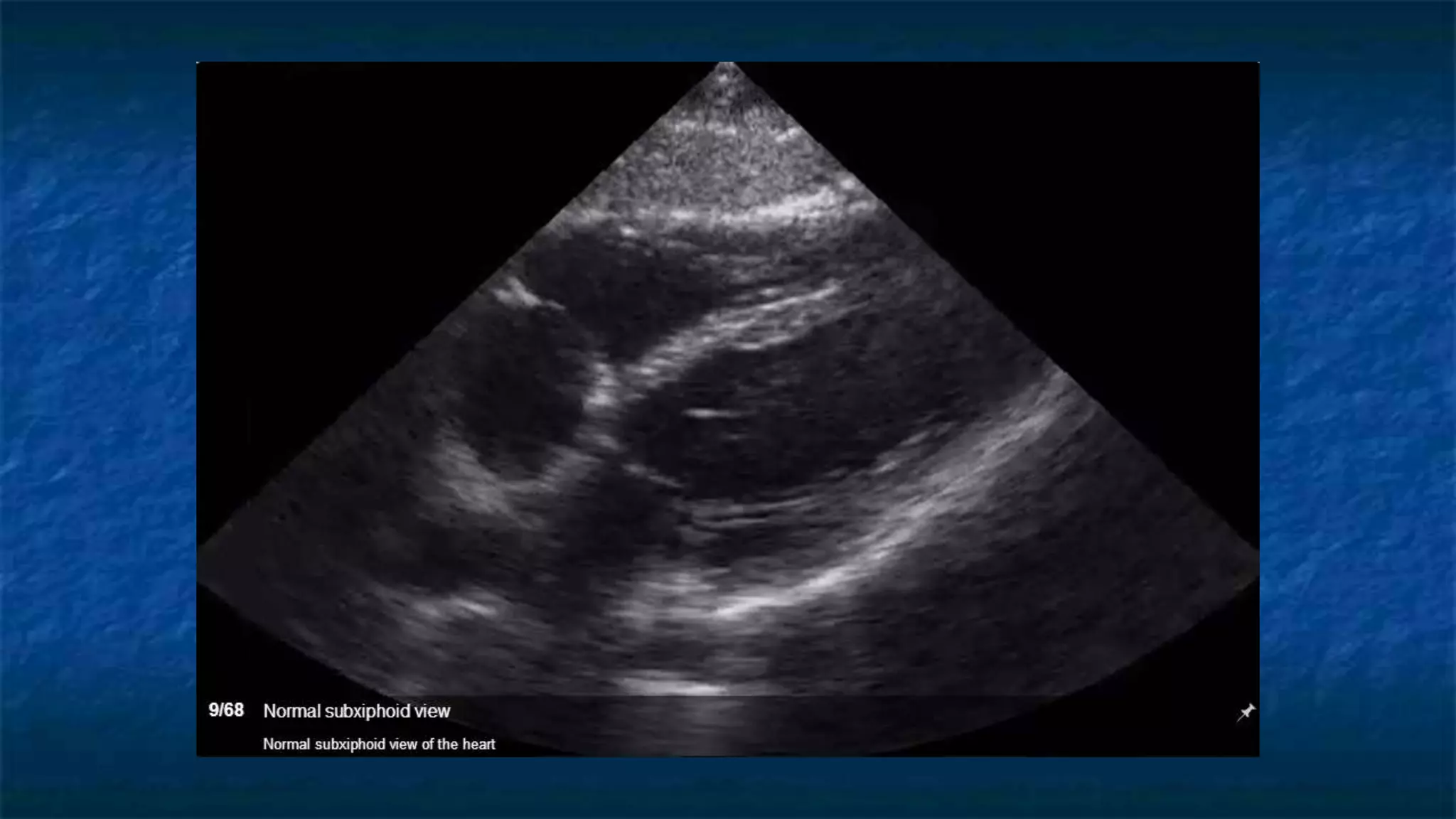 6- Abdominal Trauma and FAST Scan.pptx