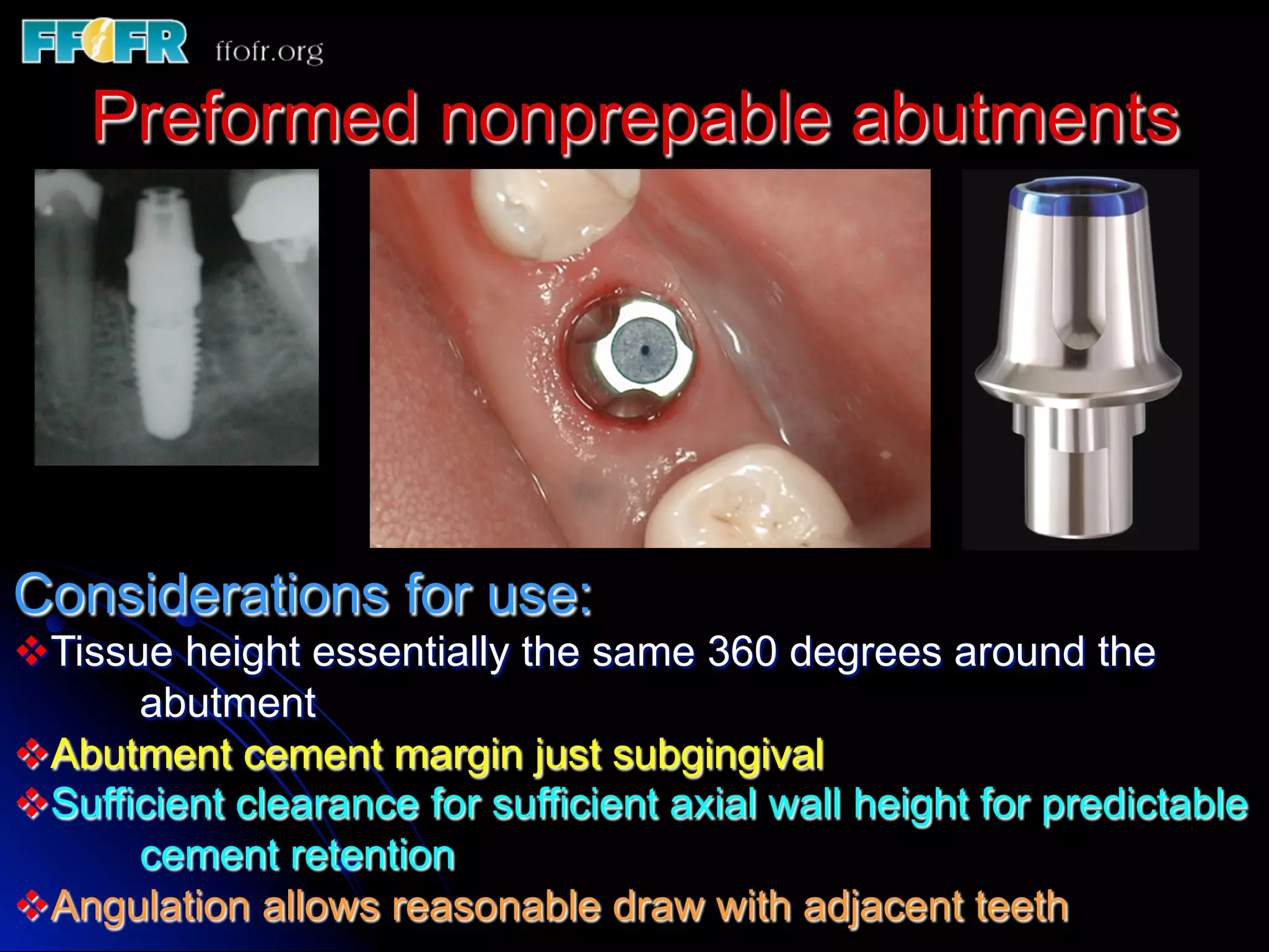 Abutment Selection | PDF