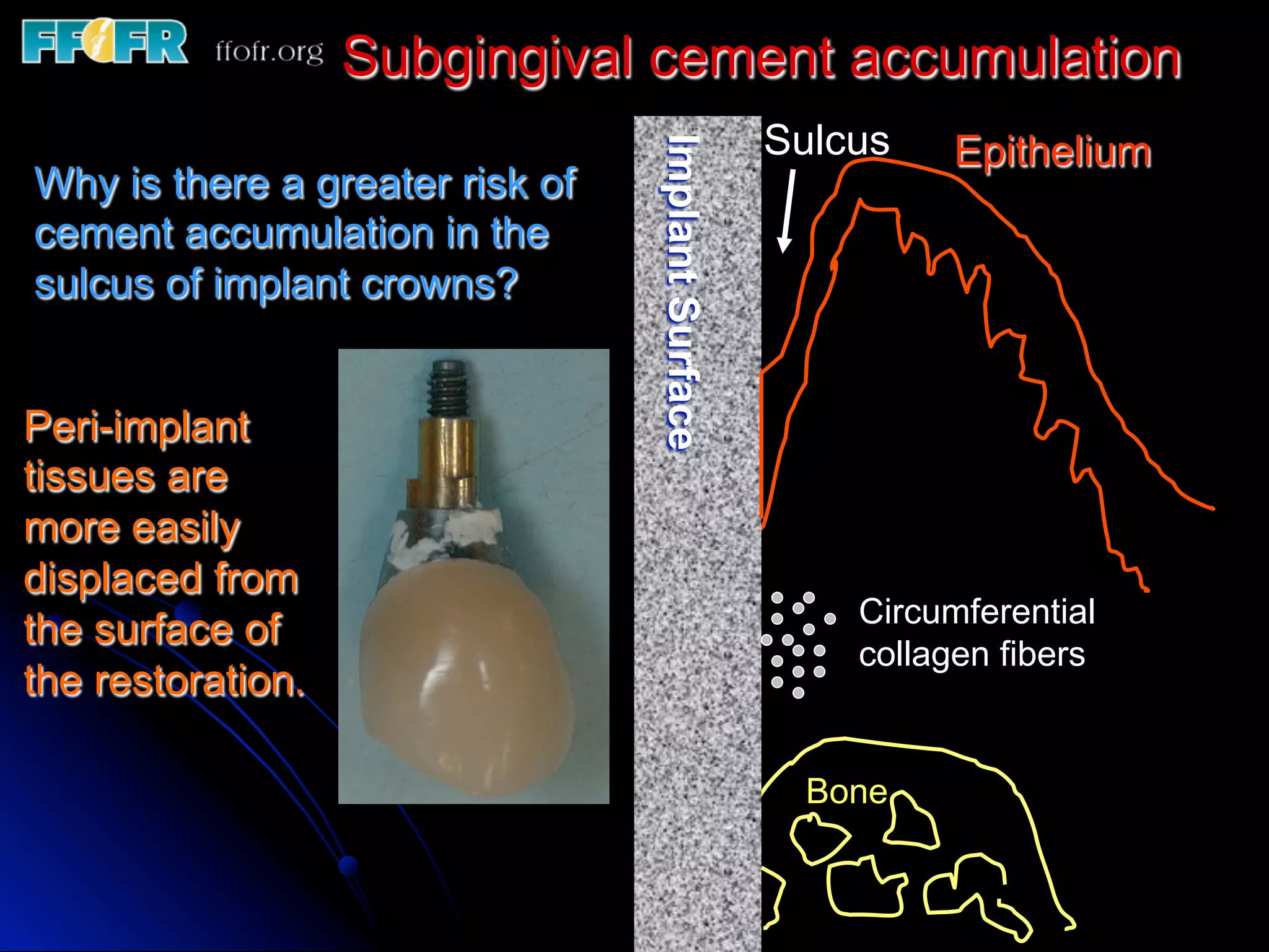 Abutment Selection | PDF