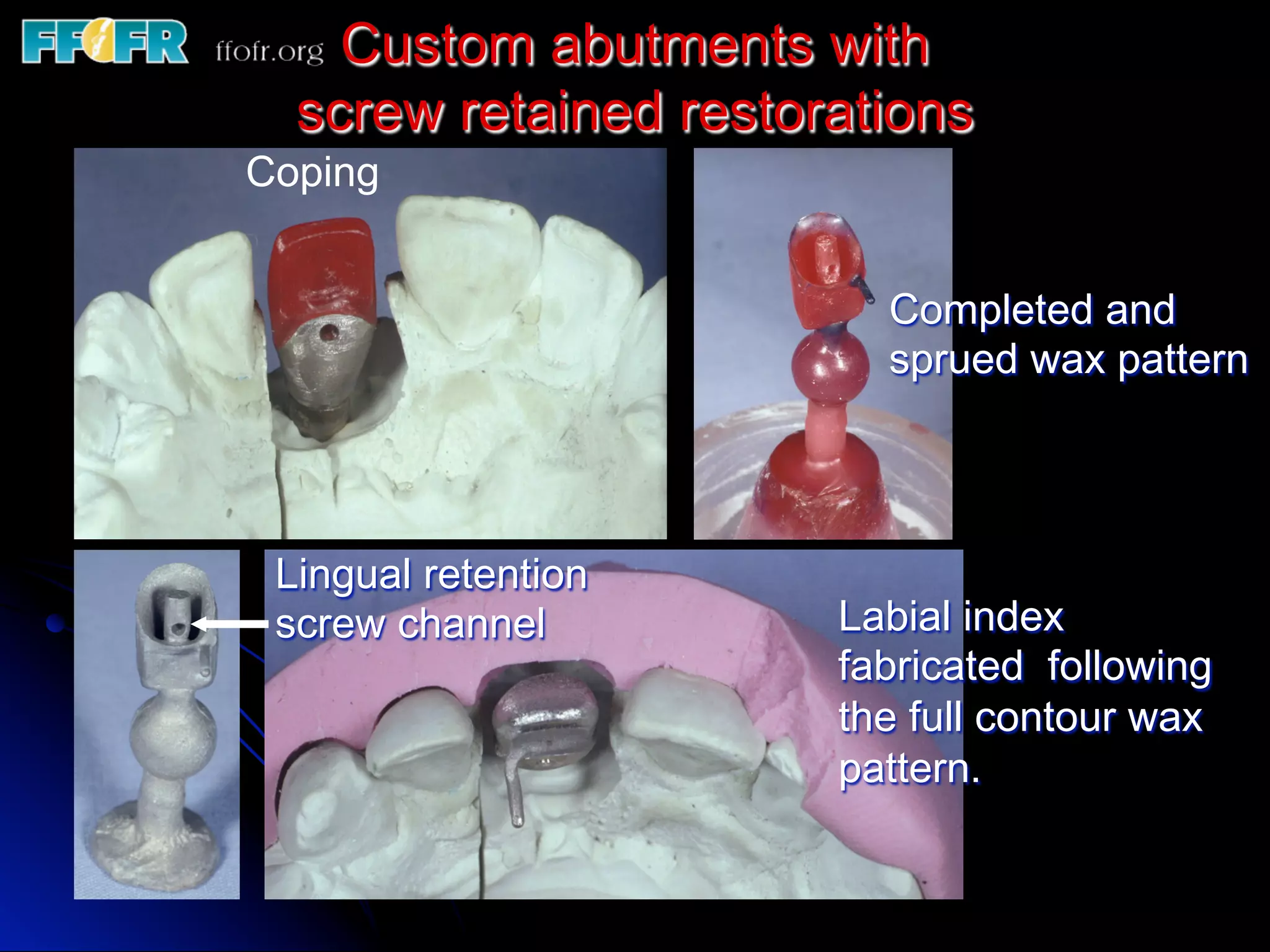 Abutment Selection | PDF