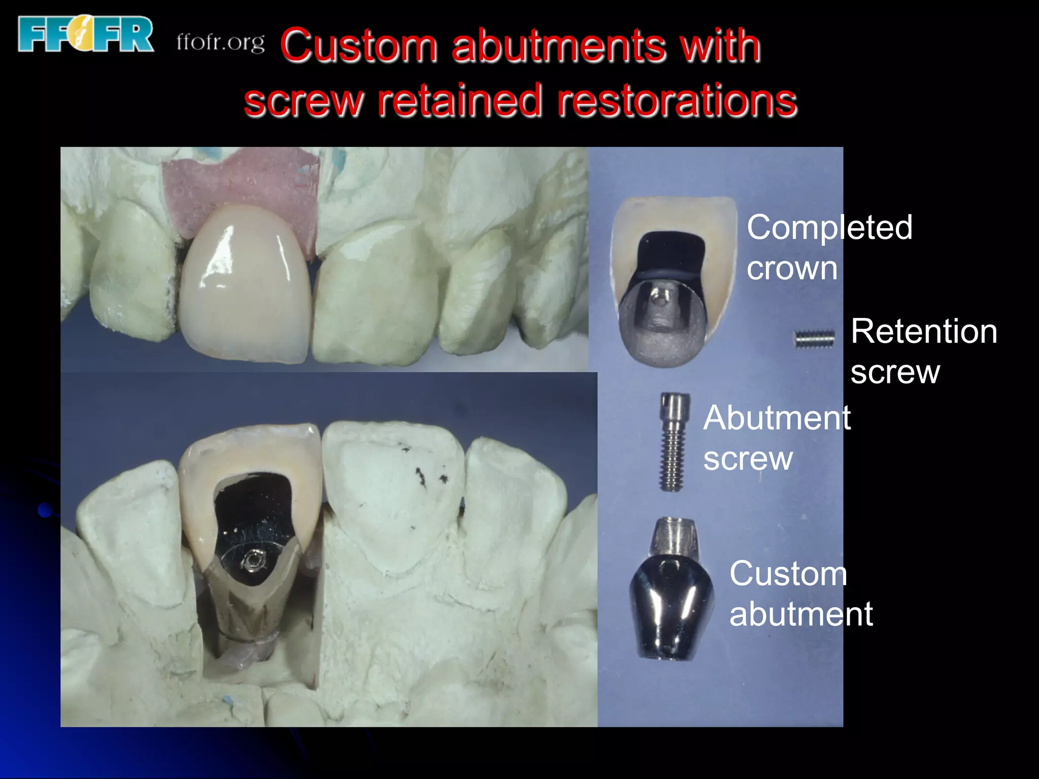 Abutment Selection | PDF