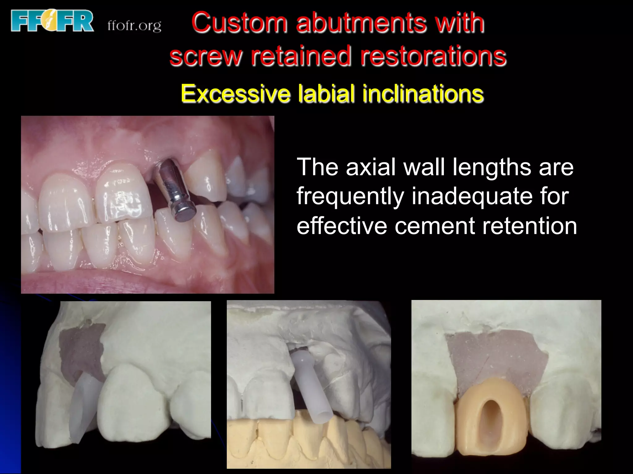 Abutment Selection | PDF