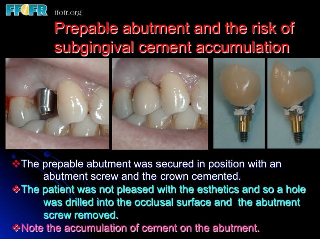Abutment Selection | PDF | Dental Health | Diseases and Conditions