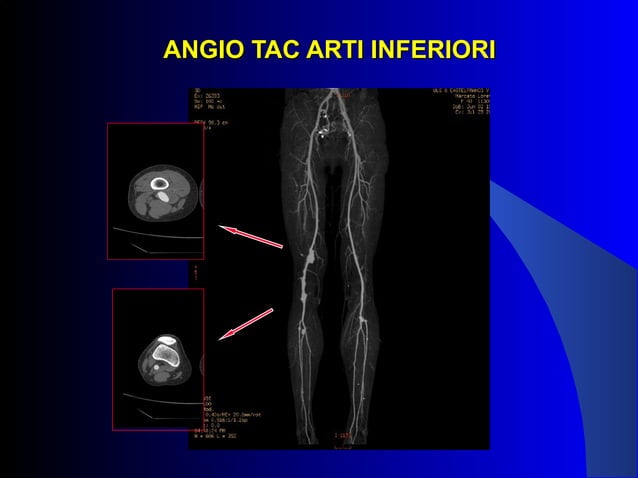 BILATERAL TIBIAL ARTERY ANEURYSMS | PPT | Medical Health