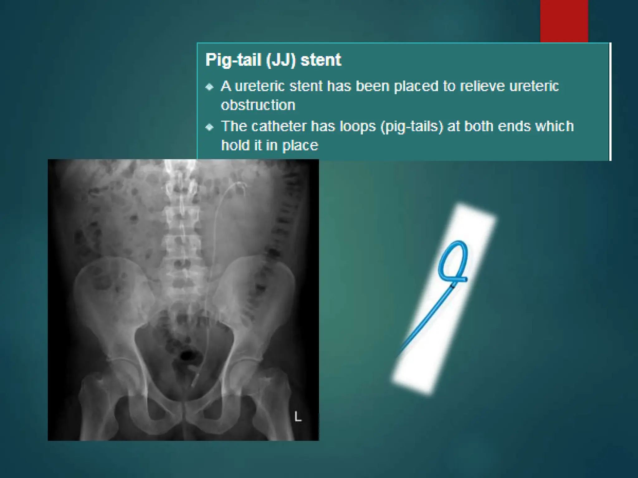 ABDOMINAL XRAYS- CALCIFICATIONS MEDICAL DEVICES X RAY ABDOMEN. | PDF