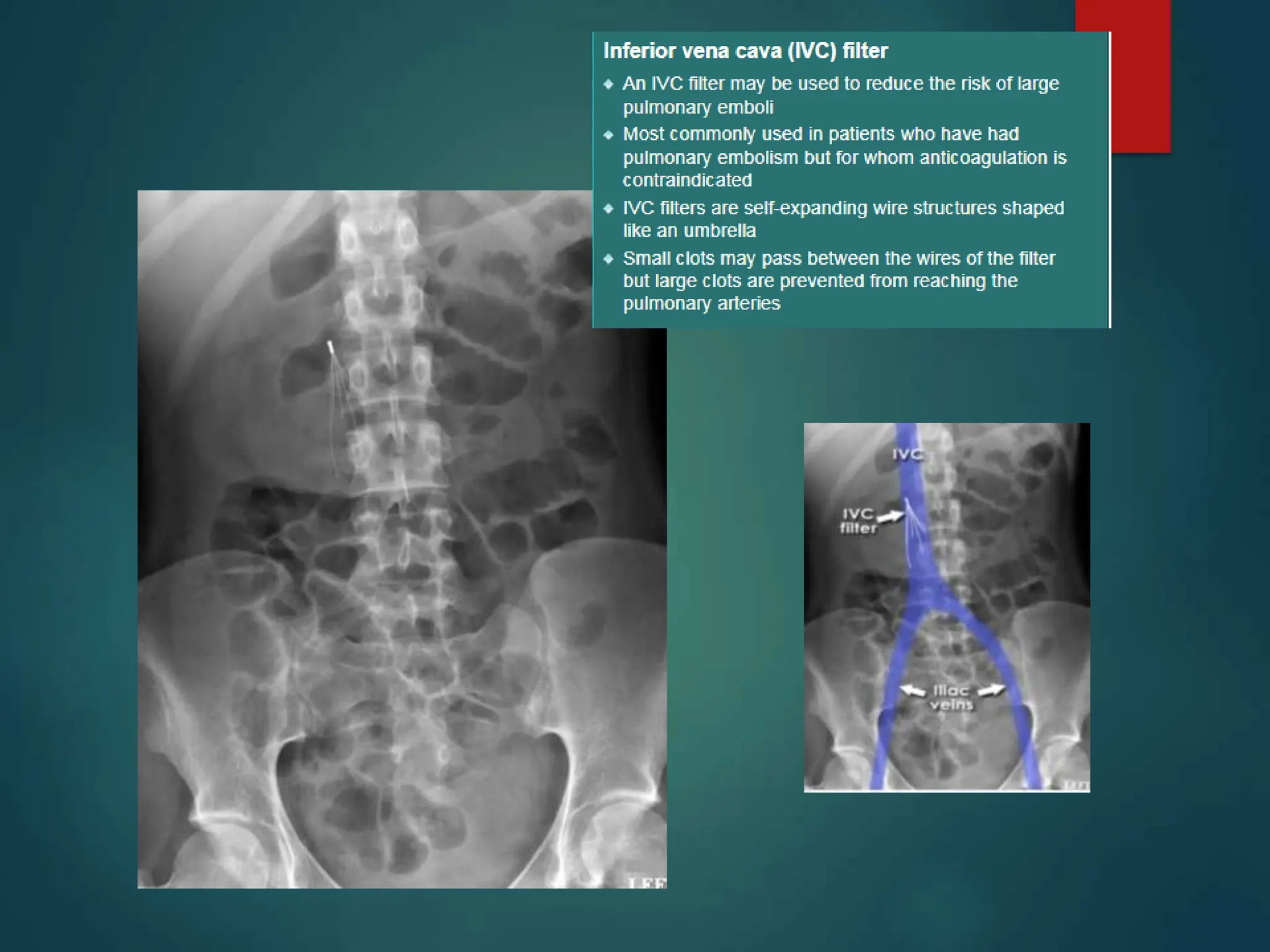 ABDOMINAL XRAYS- CALCIFICATIONS MEDICAL DEVICES X RAY ABDOMEN. | PDF