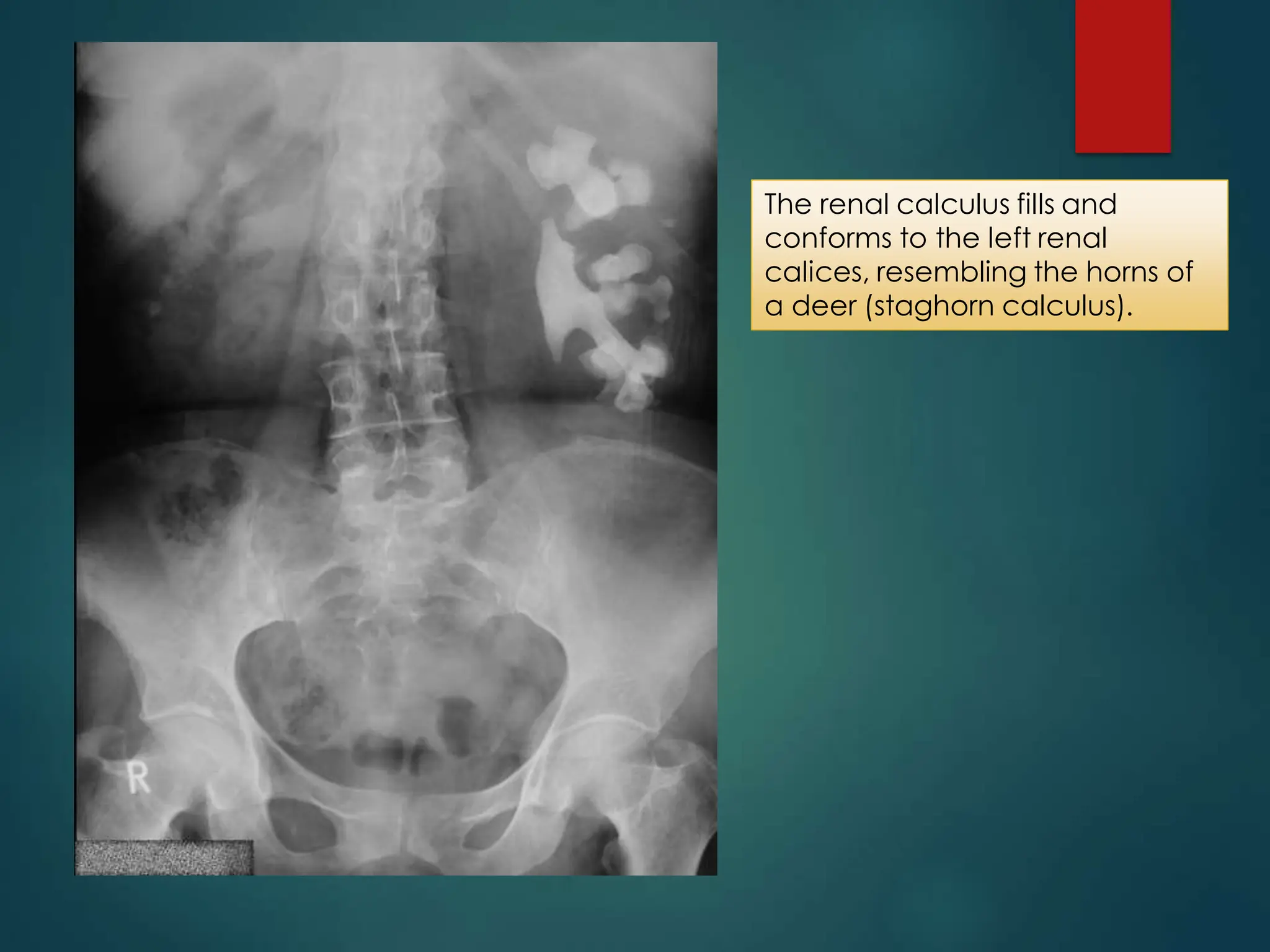 ABDOMINAL XRAYS- CALCIFICATIONS MEDICAL DEVICES X RAY ABDOMEN. | PDF