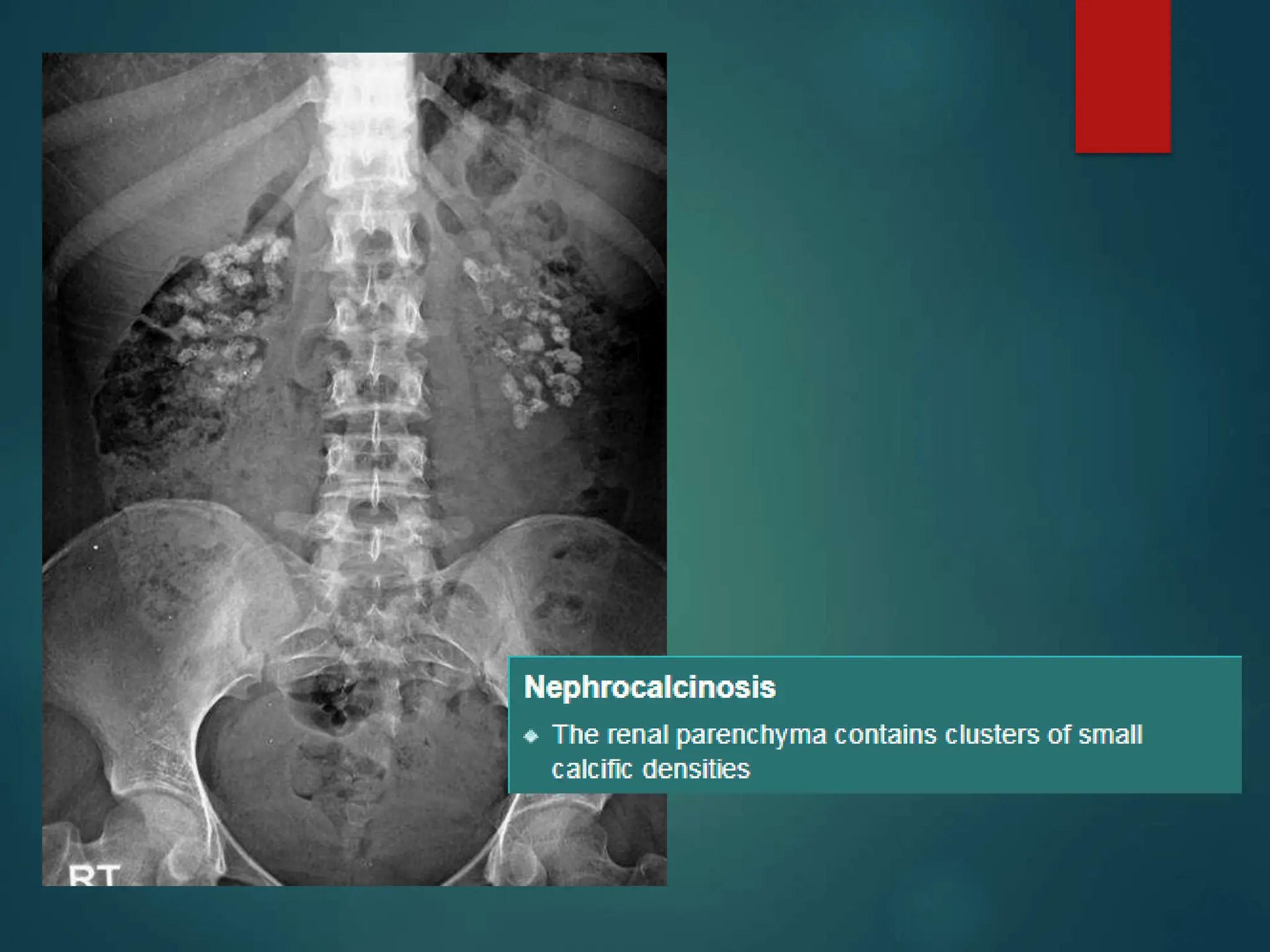 ABDOMINAL XRAYS- CALCIFICATIONS MEDICAL DEVICES X RAY ABDOMEN. | PDF