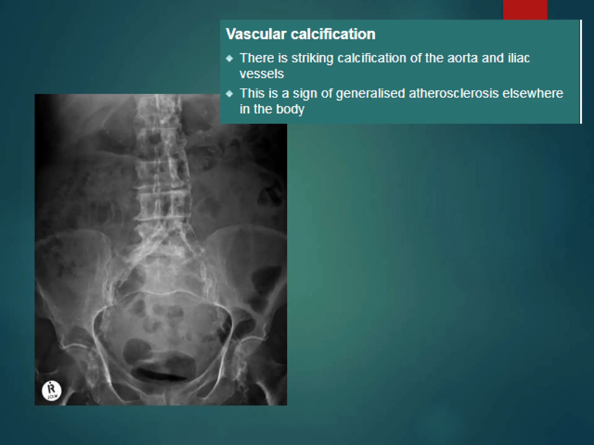 ABDOMINAL XRAYS- CALCIFICATIONS MEDICAL DEVICES X RAY ABDOMEN. | PDF