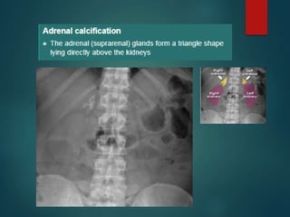 ABDOMINAL XRAYS- CALCIFICATIONS MEDICAL DEVICES X RAY ABDOMEN. | PPT