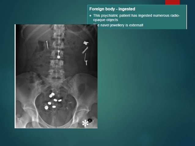 ABDOMINAL XRAYS- CALCIFICATIONS MEDICAL DEVICES X RAY ABDOMEN. | PDF
