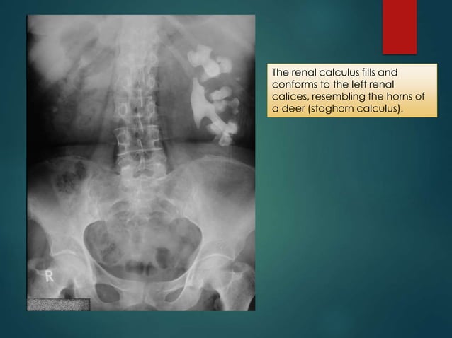 ABDOMINAL XRAYS- CALCIFICATIONS MEDICAL DEVICES X RAY ABDOMEN. | PDF