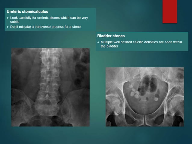 ABDOMINAL XRAYS- CALCIFICATIONS MEDICAL DEVICES X RAY ABDOMEN. | PDF