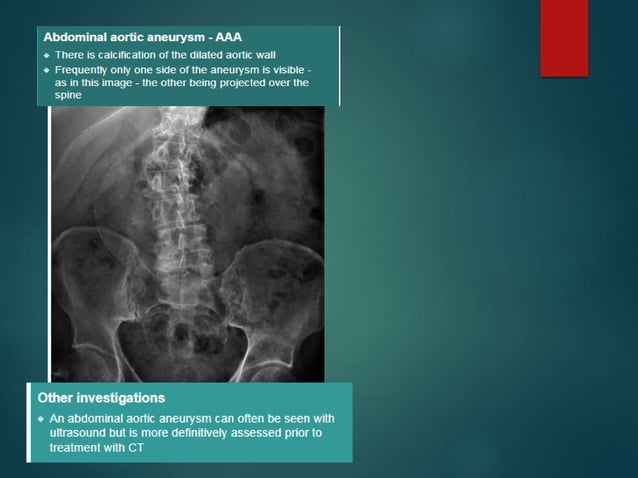 ABDOMINAL XRAYS- CALCIFICATIONS MEDICAL DEVICES X RAY ABDOMEN. | PDF