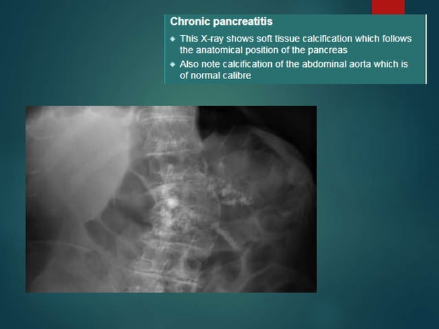 ABDOMINAL XRAYS- CALCIFICATIONS MEDICAL DEVICES X RAY ABDOMEN. | PDF
