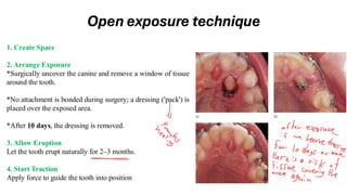 canine-impaction In dentistry oral health | PDF